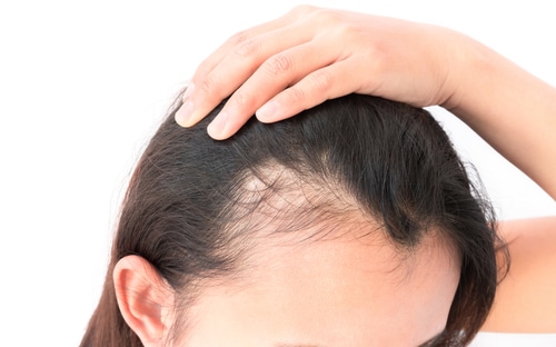 Hair Loss | Aesthetic Associates Centre for Plastic Surgery | Buffalo NY